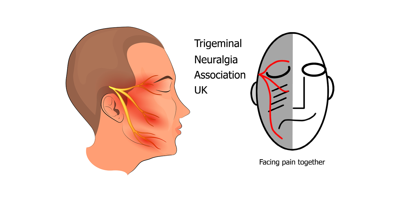 Trigeminal Neuralgia Association - RH Uncovered Trigeminal Neuralgia Association - RH Uncovered